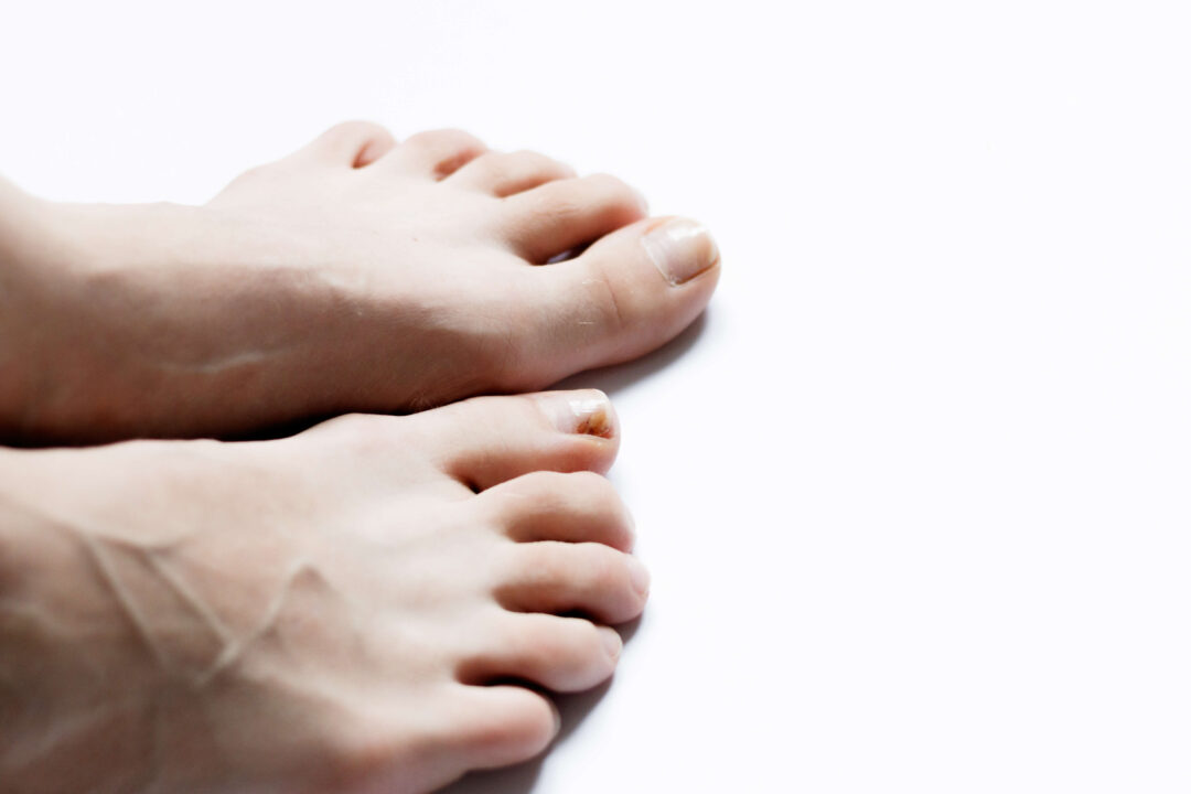 Top 5 Warning Signs of Fungal Toenails | Silver Spring Foot & Ankle